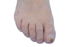 Dermatophyten - Vorkommen, Verbreitung und Eigenschaften » Krank.de