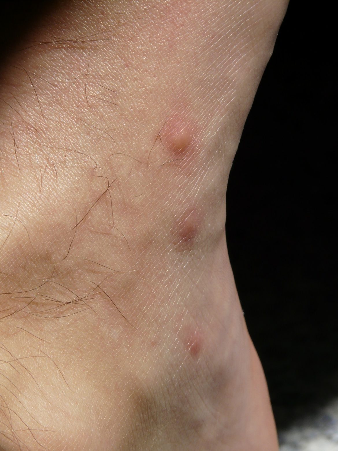 Was ist Akne inversa? - Ursachen, Symptome, Behandlung » Krank.de